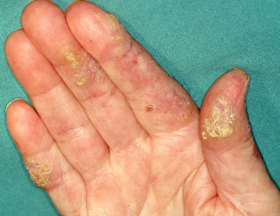 Pemphigus vulgaris — Medlibes: Online Medical Library