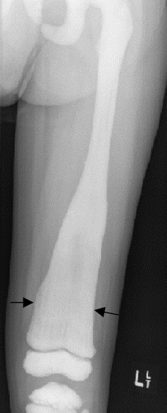 Gaucher's disease — Medlibes: Online Medical Library