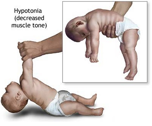 Prader-Willi syndrome — Medlibes: Online Medical Library